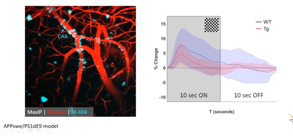 Unraveling microinfarts and microbleeds in cerebral amyloid angiopathy ...